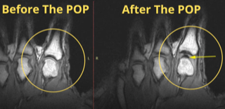 Crack, click, pop, what's it all about? - Spinal Care Clinics